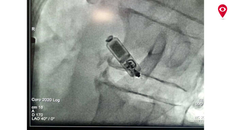 World’s smallest pacemaker implanted at Saifee hospital | Mumbai Live